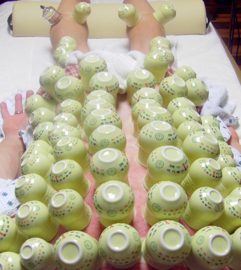 MS Acupuncture Clinic INC. - Cupping